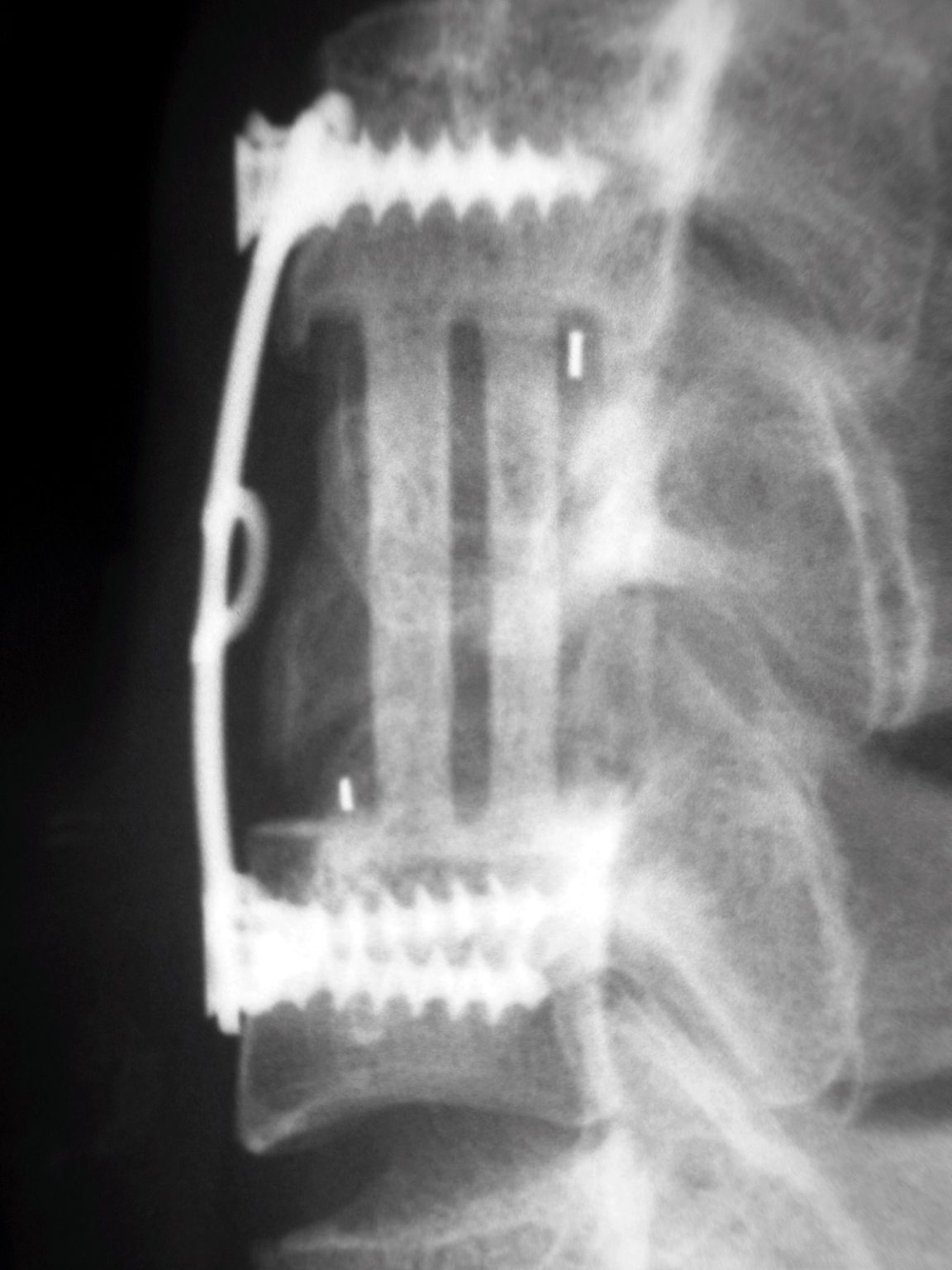 Trabis corporectomie – nexiscoligne